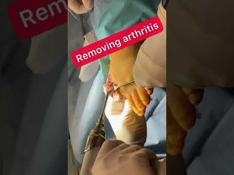 Removing arthritis from great toe joint | #shorts