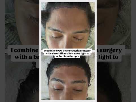 Brow bone reduction before and after | Dr. Sarah Saxon
