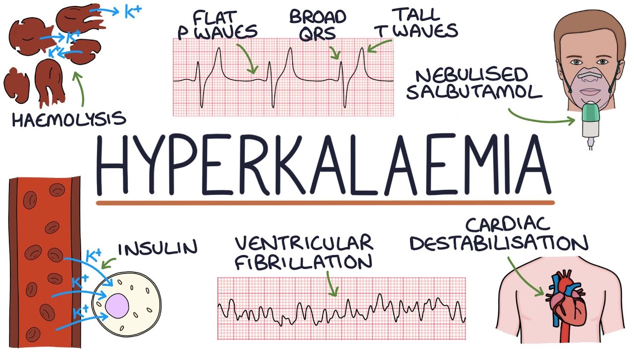 Understanding Hyperkalaemia (High Potassium)