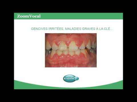 Comment soigner gencive rouge ? La réponse est sur Admicile.fr