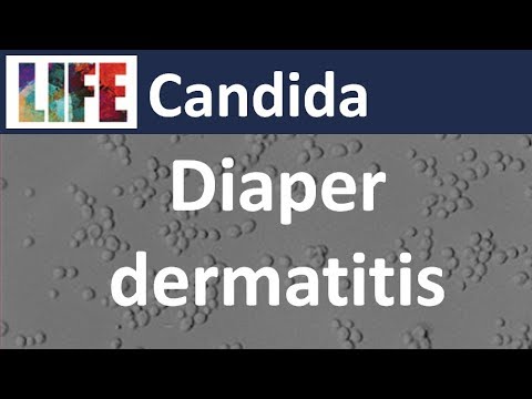 Candida diaper dermatitis (part 2/3)