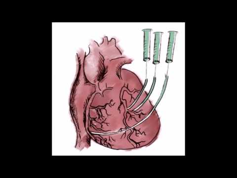 Direct ICG injection through saphenous vein grafts