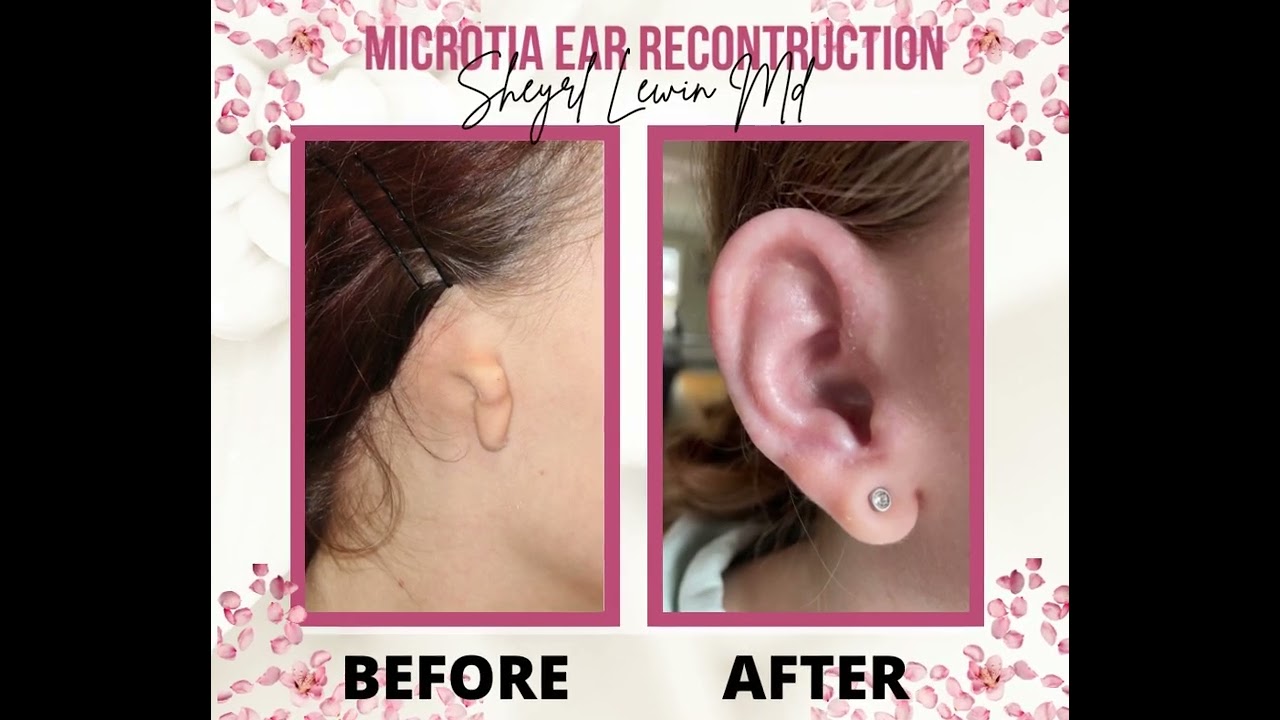 Microtia Ear Surgery - 18 months post-op