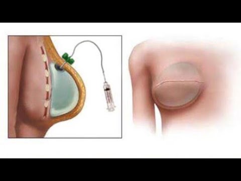 How reconstruction with breast tissue expanders go wrong, removal #breastcancer #cancerawareness