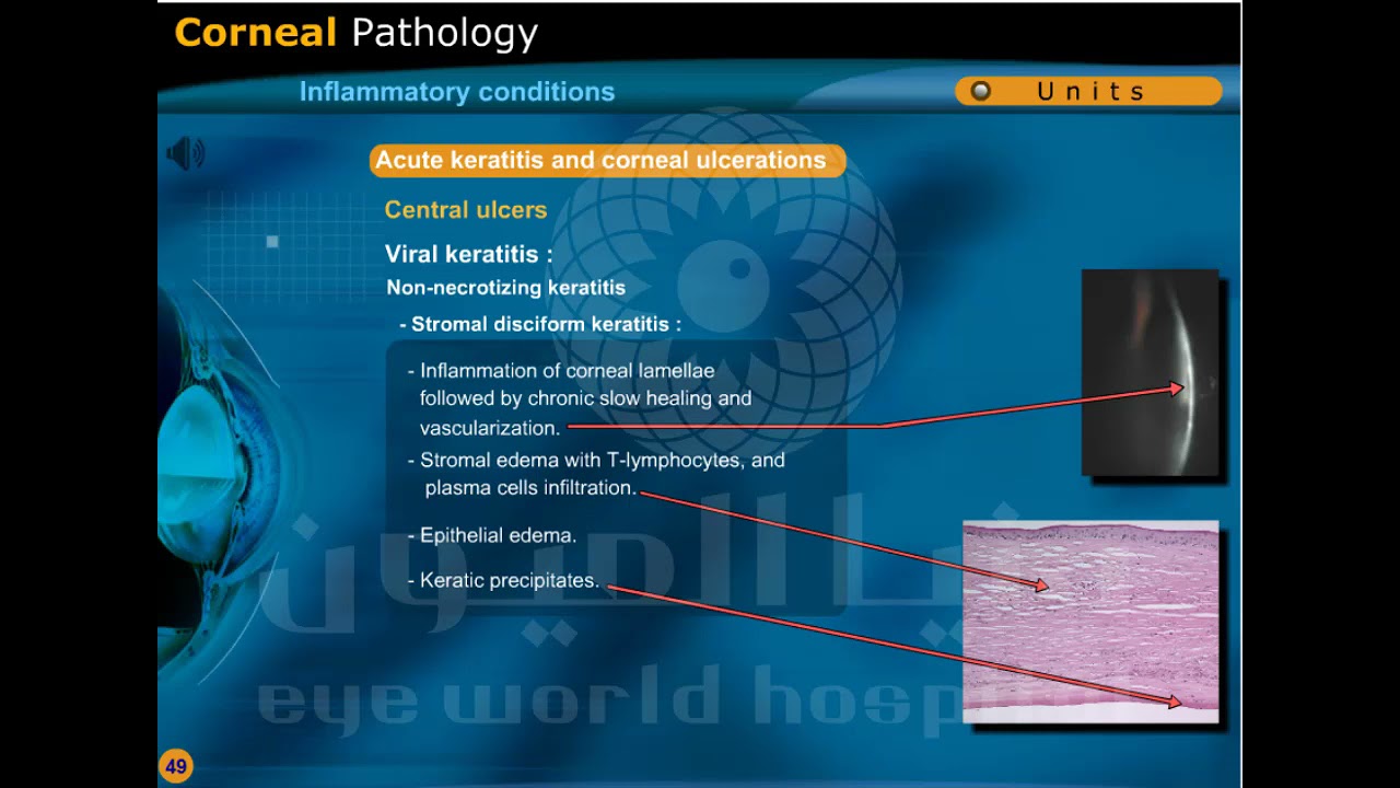 corneal rings and inflammatory conditions