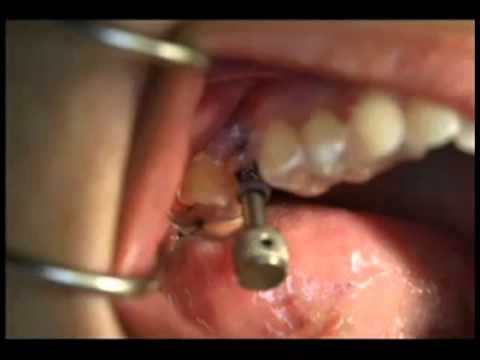 Imtec Mini Dental Implants to replace missing tooth