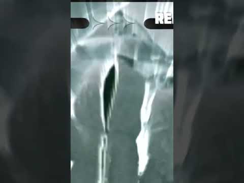 Broken Funny Bone They Have Rebuilt Her! #funnybone #surgeryrecovery #humerus
