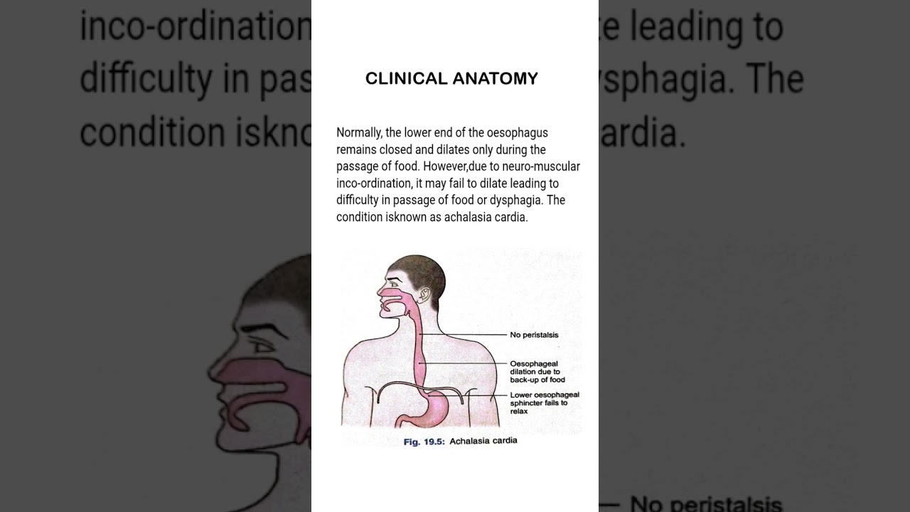 Achalasia Cardia | Clinical Anatomy Explained with Diagram