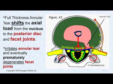 Anatomy of the Nucleus Pulposus & Annulus Fibrosus + the Effect of Annular Tears