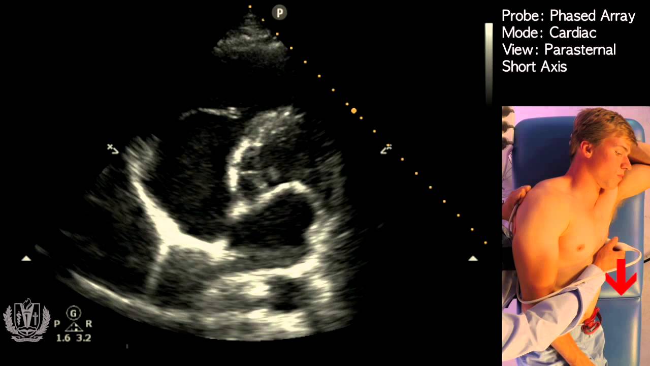 Parasternal Short Axis View - Transthoracic Echocardiography (Ultrasound)