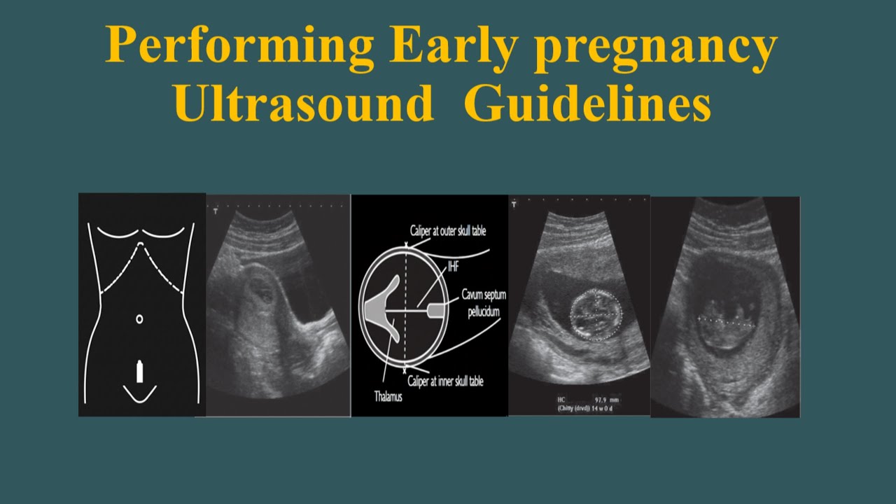 Early pregnancy ultrasound guidelines