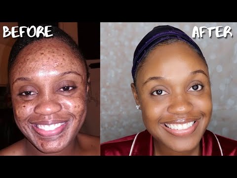 AFFORDABLE SKIN CARE ROUTINE FOR ACNE, DARK MARKS, AND HYPERPIGMENTATION