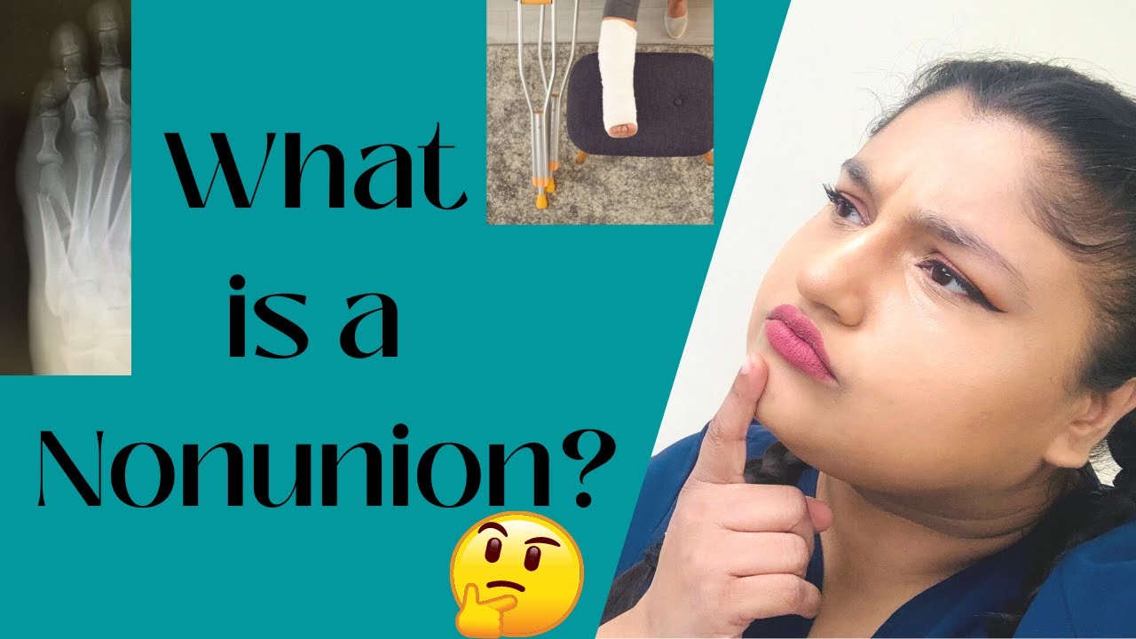 What is a nonunion?