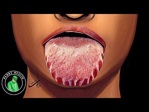 Large Tongue - Macroglossia: Patient Education