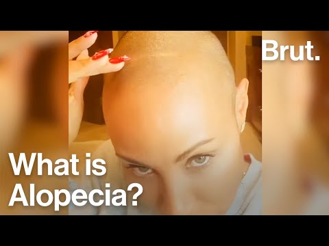 What is Alopecia?