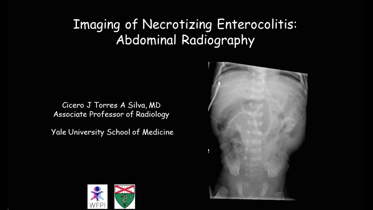 Necrotizing enterocolitis