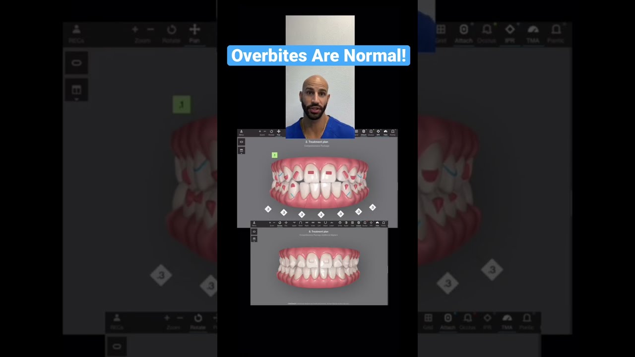 Overbites Are Normal!
