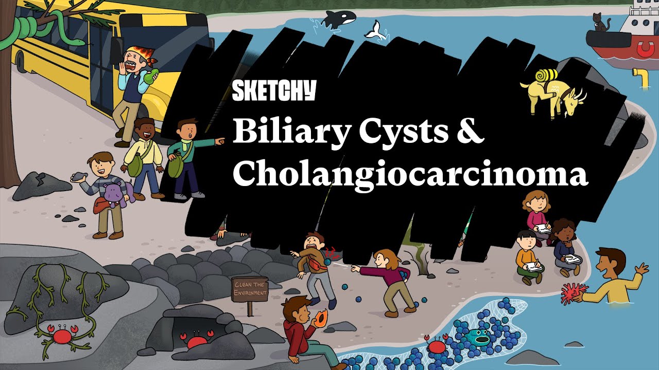 Biliary Cysts & Cholangiocarcinoma (Full Lesson)| Sketchy Medical | USMLE Step 1