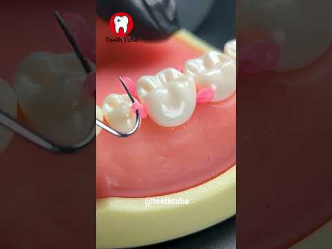Orthodontic Spacers #shorts
