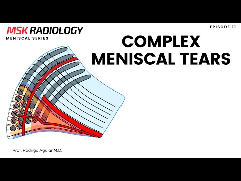 Complex Meniscal Tear on MRI