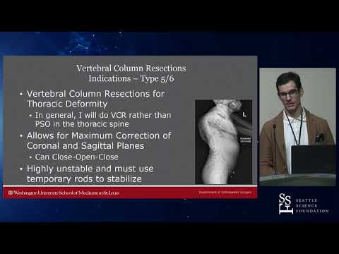 Osteotomies in Spinal Deformity - Michael P. Kelly, MD