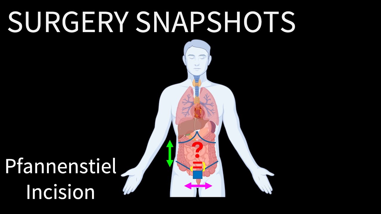 Accessing the Abdomen by Pfannenstiel Incision for the Robotic Low Anterior Resection (LAR)
