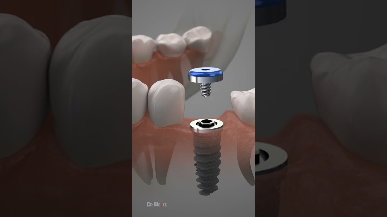 Dental Implant Procedure