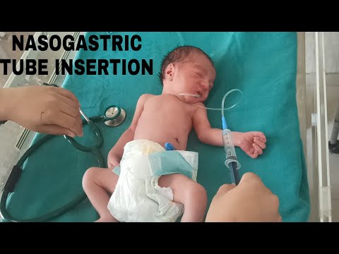 Nasogastric ( NG ) Tube Insertion In Neonate | Orogastric Tube | Feeding Tube