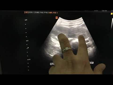 Cross fused reanal ectopia