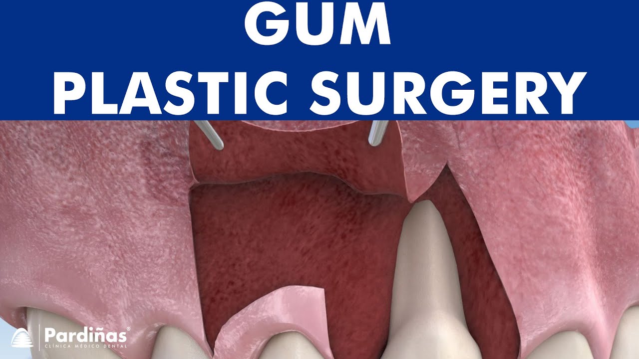 Gum plastic surgery - Laterally positioned flap for root coverage ©