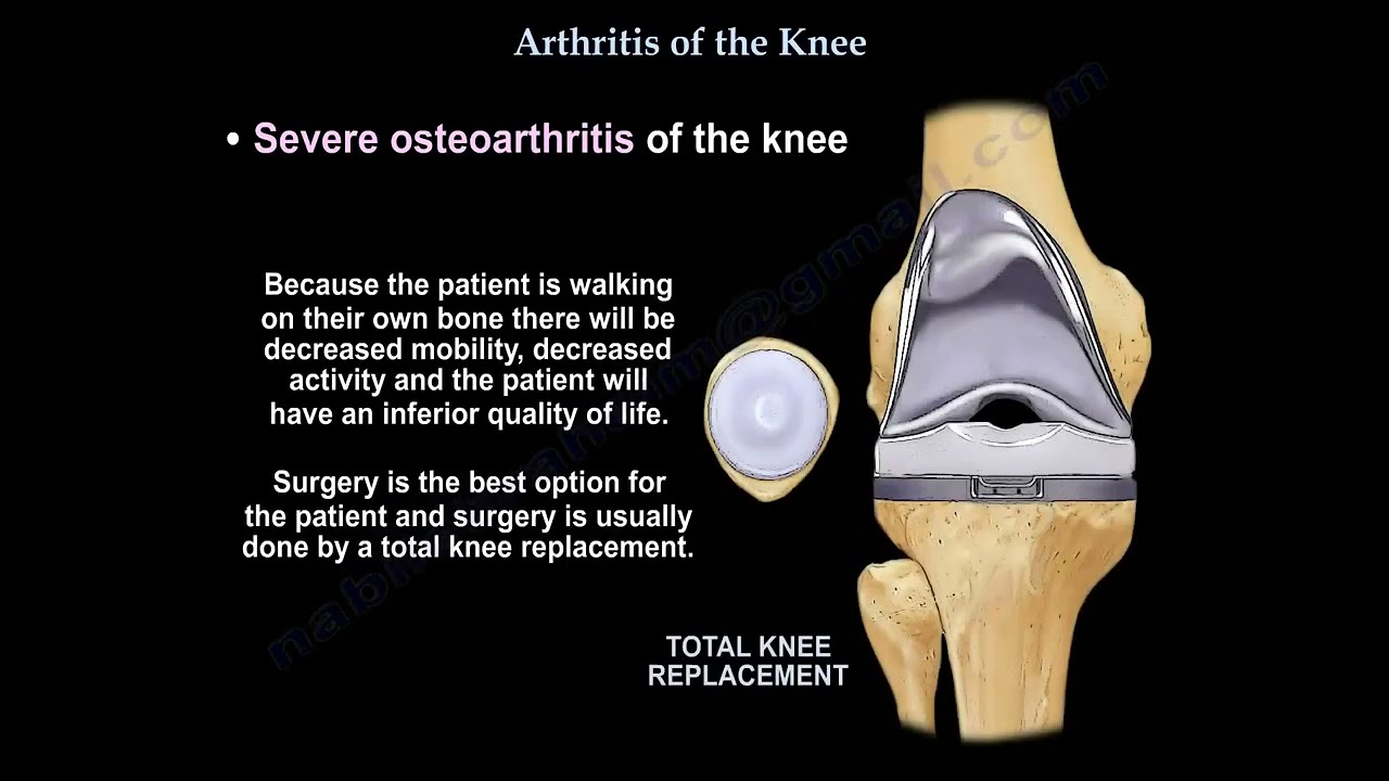 Knee arthritis, causes,  symptoms, diagnosis  and treatment