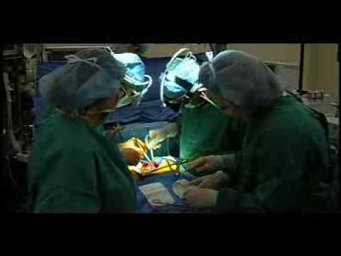 Mitral Valve Prolapse