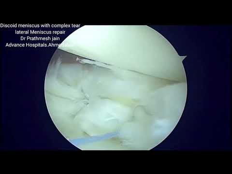 Lateral discoid meniscus with tear (hindi commentory)