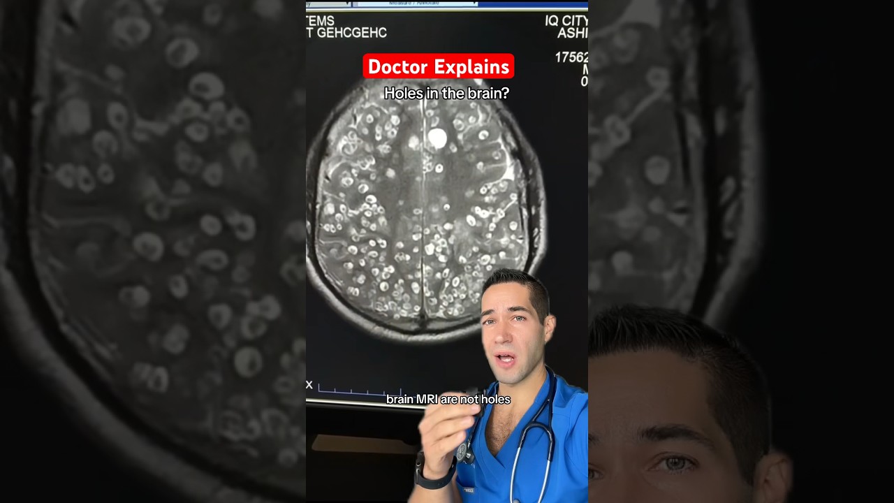 He ate THIS and it caused holes in his brain?!! 🫣