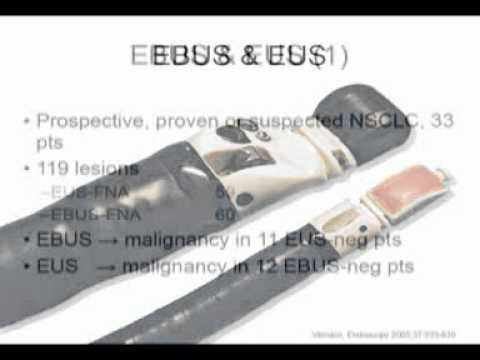EBUS - Dr. Rice - 25th Annual GTSC Meeting