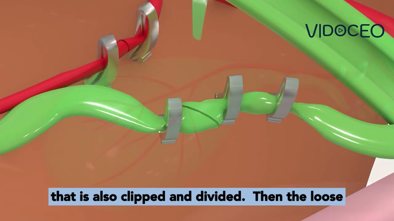 Laparoscopic cholecystectomy explained by surgeon
