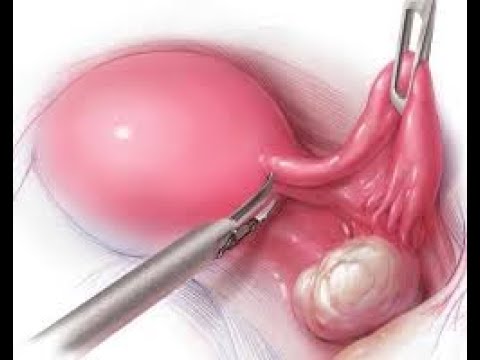 Oophorectomy CPT codes - simplify medical coding
