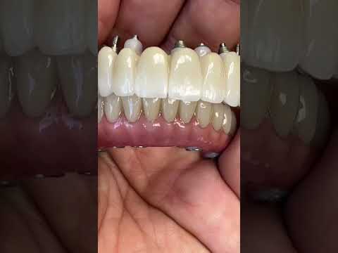 No Pink vs. Pink Esthetic for Full Mouth Zirconia Implants