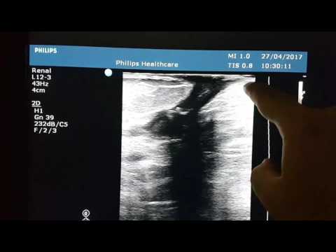 Stitch Granuloma Sonograohy