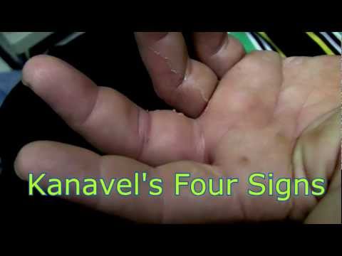 Pyogenic Flexor Tenosynovitis - Hand - Orthobullets