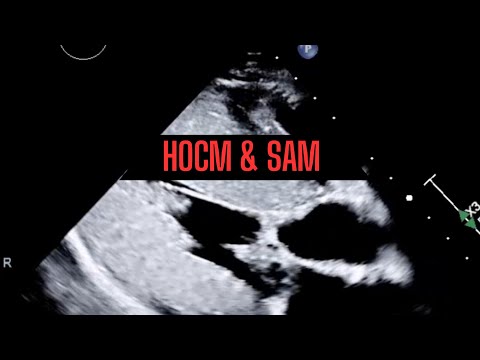 HOCM & SAM: An Ultrasound Snapshot