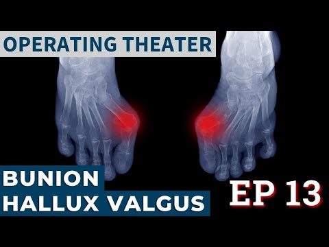 What is Bunion Hallux Valgus? - Operating Theater Ep.13