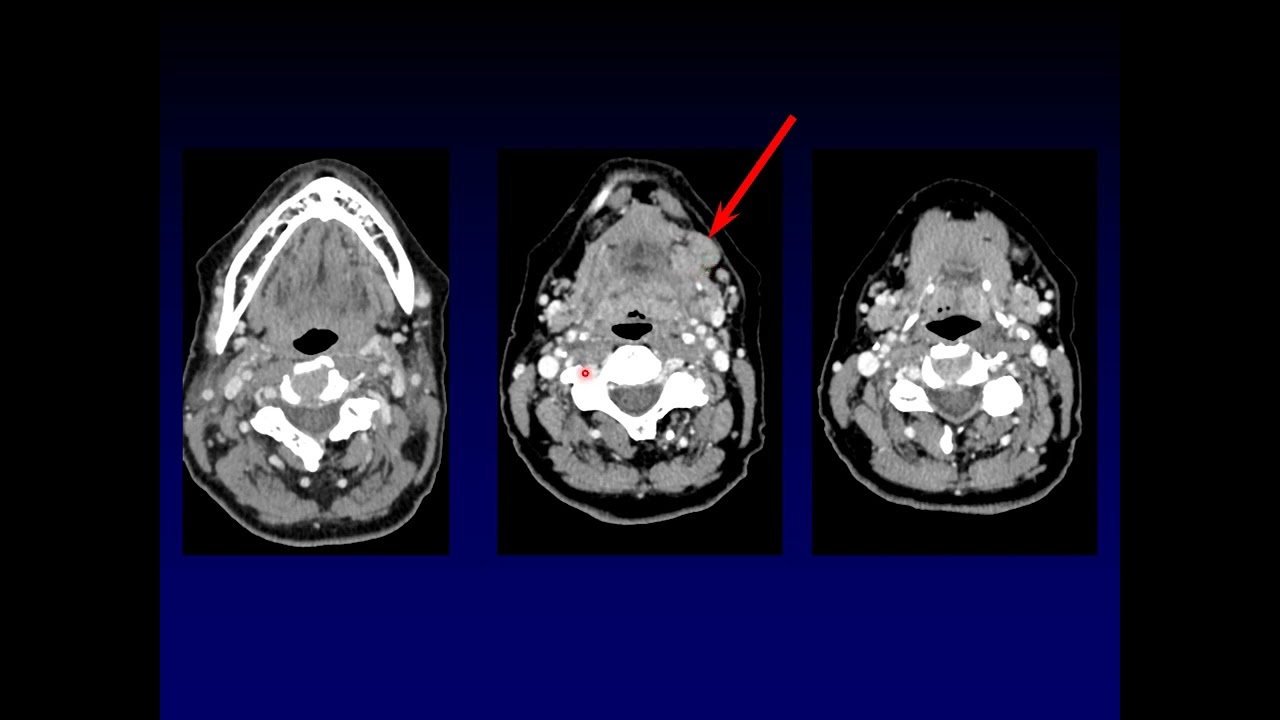 Quick Case: Submandibular Mass