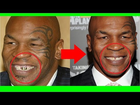 24 Celebrity Who Had Cosmetic Dental Surgery
