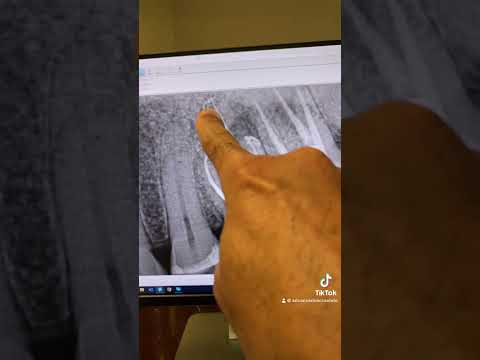 Root canal therapy of tooth #14.