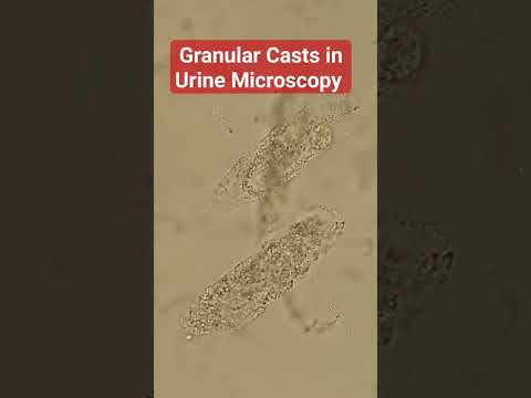 Granular Casts in Urine Microscopy