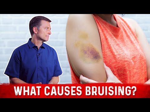 What Causes Bruising (Without Trauma) – Dr. Berg