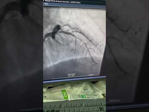 LAD CTO - proximal spot stenting and DCB