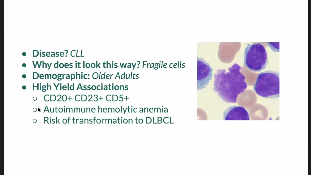 Smudge Cells & High Yield Associations — Hematology for the USMLEs