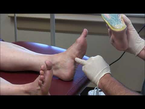 Painful Plantar Fibromas in Feet